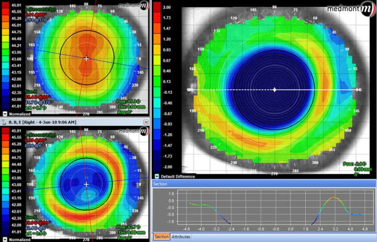 Orthokeratology | Grace & Vision Optometrist Brisbane
