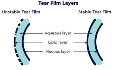 IPL: Pioneering Dry Eye Treatment