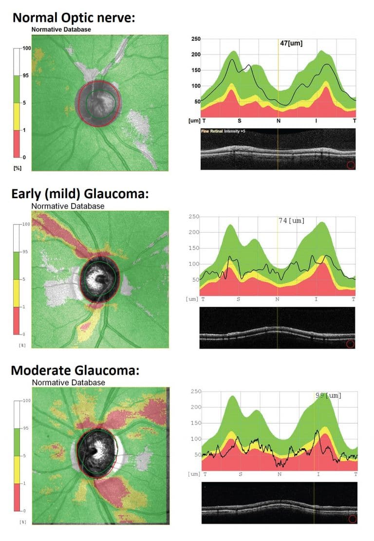 Glaucoma | Grace & Vision Optometrist Brisbane