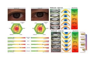 Dry Eye Assessment | Grace & Vision Optometrist
