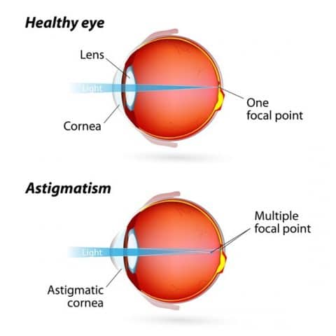 Contact Lenses | Grace & Vision Optometrist Brisbane